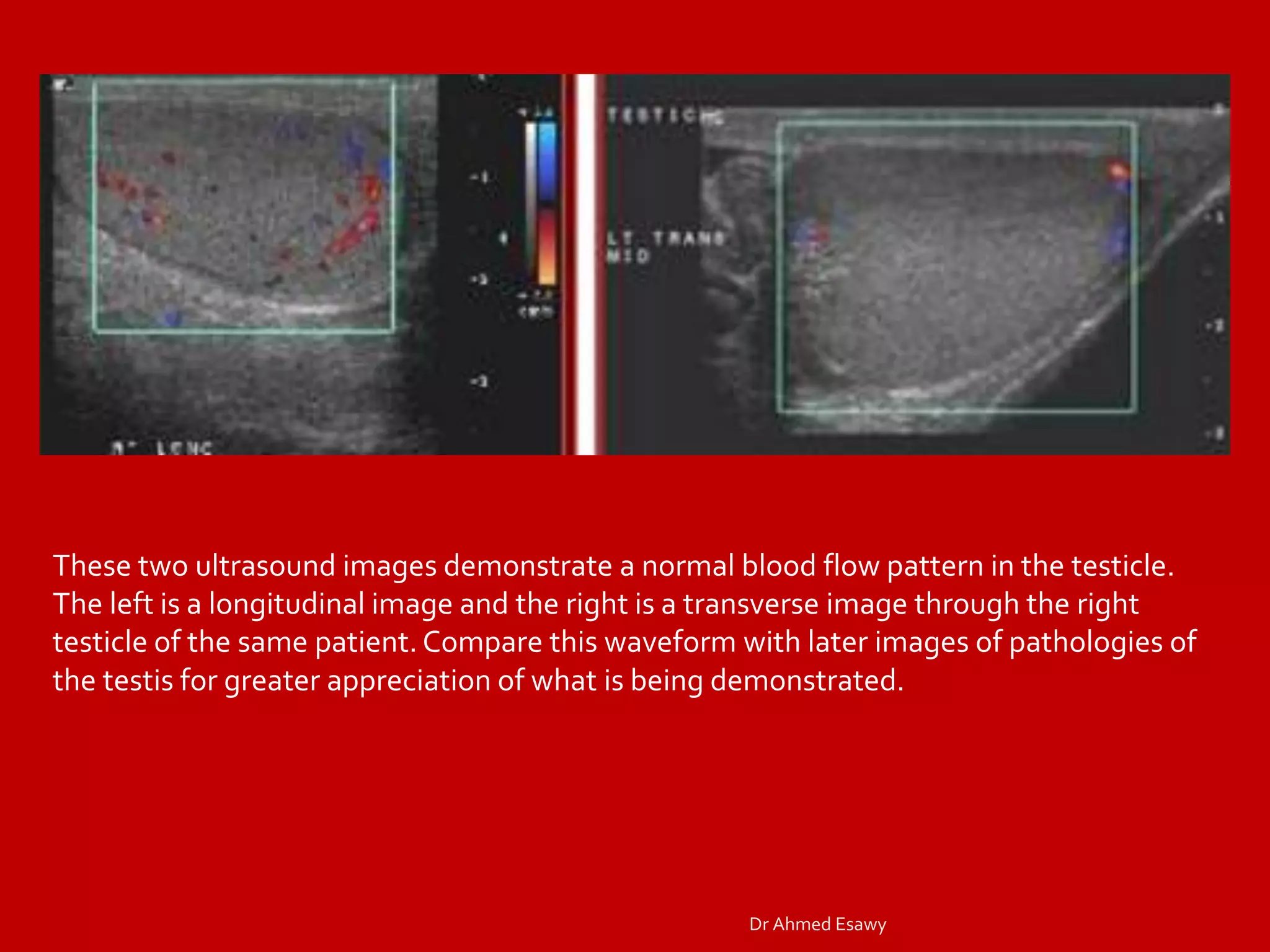 Imaging orchitis epidydmitis epidydmo orchitis DrAhmed Esawy | PDF