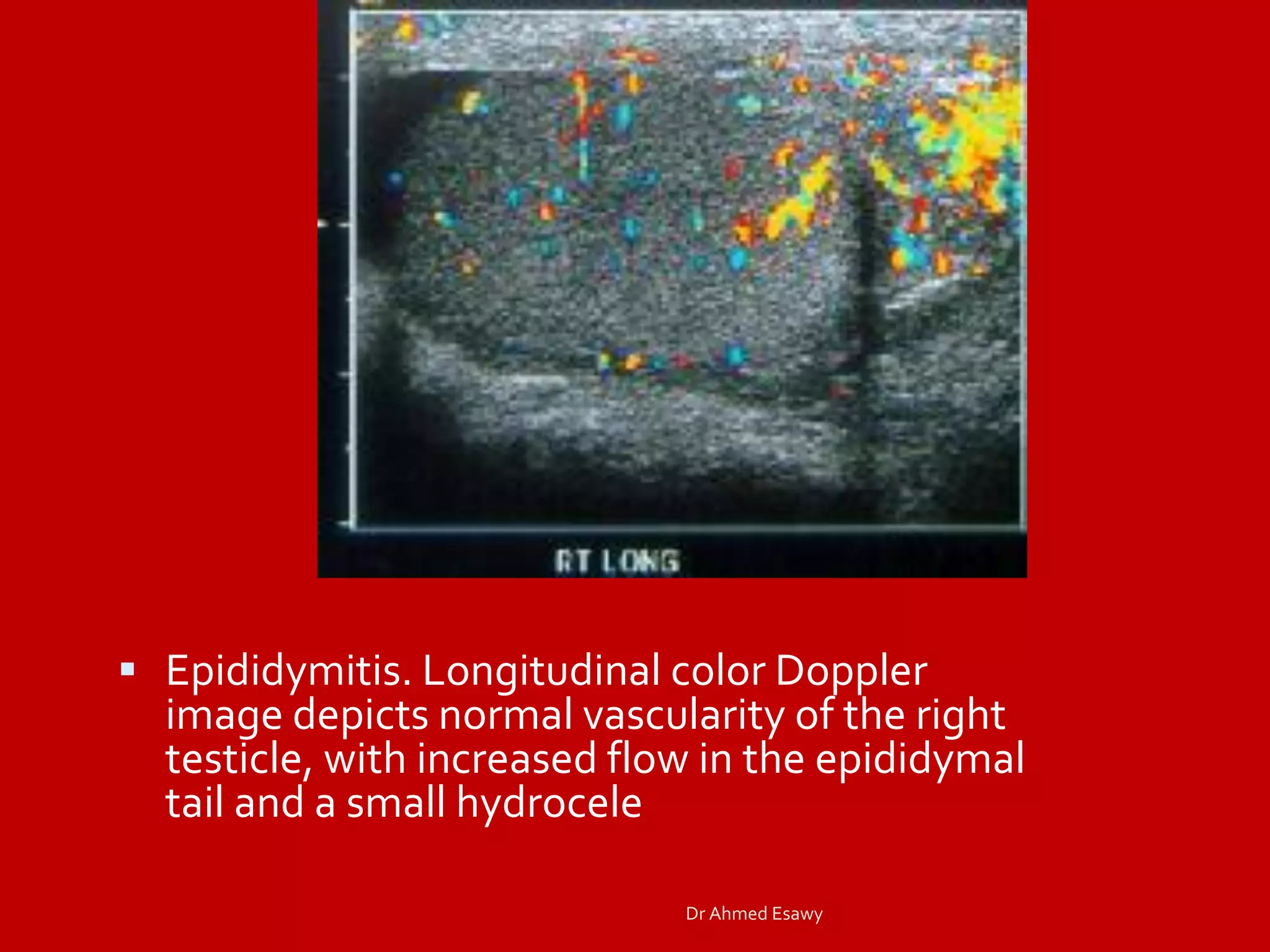 Imaging orchitis epidydmitis epidydmo orchitis DrAhmed Esawy | PDF
