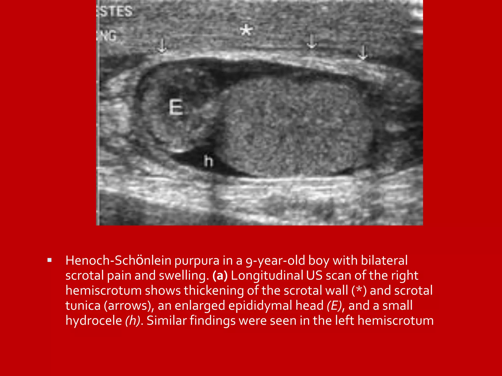 Imaging orchitis epidydmitis epidydmo orchitis DrAhmed Esawy | PDF