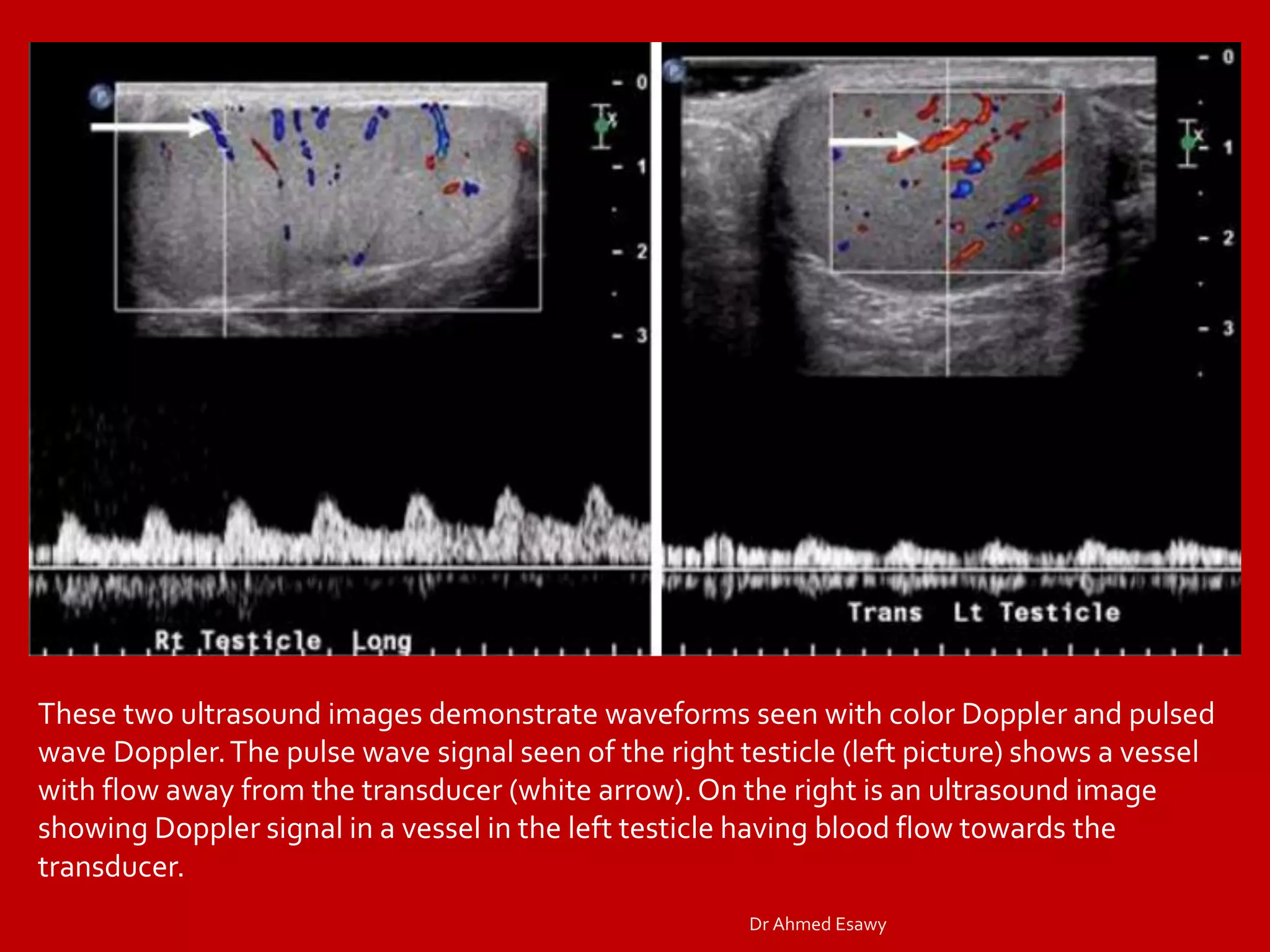 Imaging orchitis epidydmitis epidydmo orchitis DrAhmed Esawy | PDF