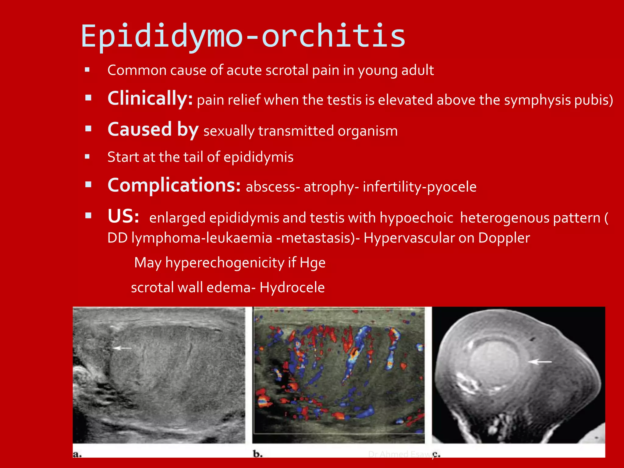 Imaging orchitis epidydmitis epidydmo orchitis DrAhmed Esawy | PDF