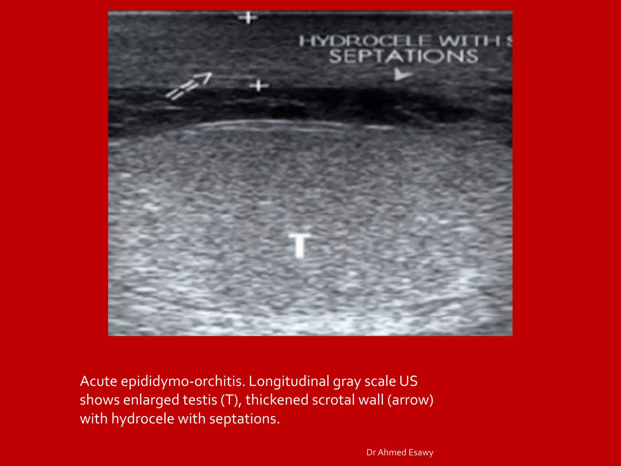 Imaging orchitis epidydmitis epidydmo orchitis DrAhmed Esawy | PDF