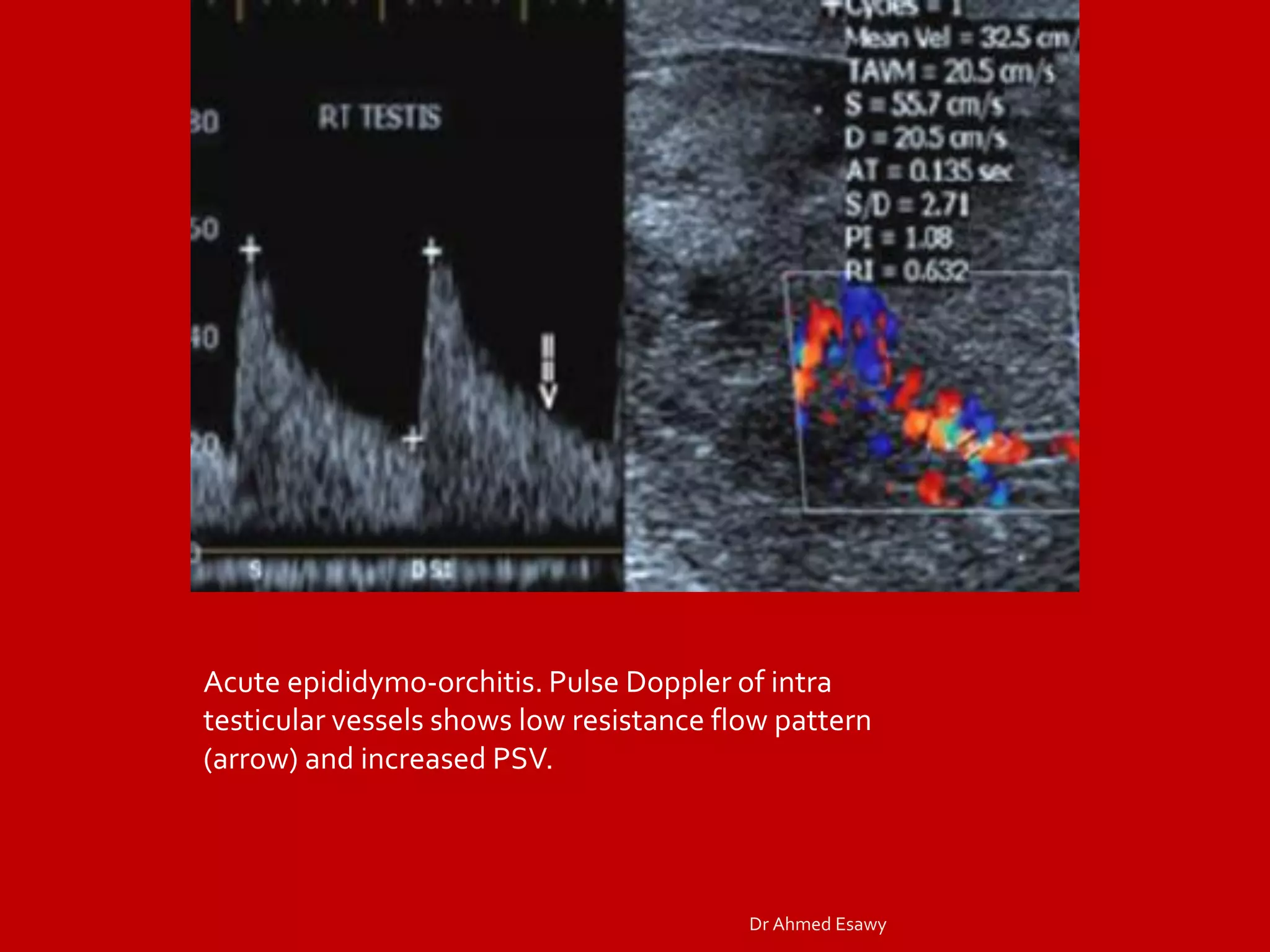 Imaging orchitis epidydmitis epidydmo orchitis DrAhmed Esawy | PDF