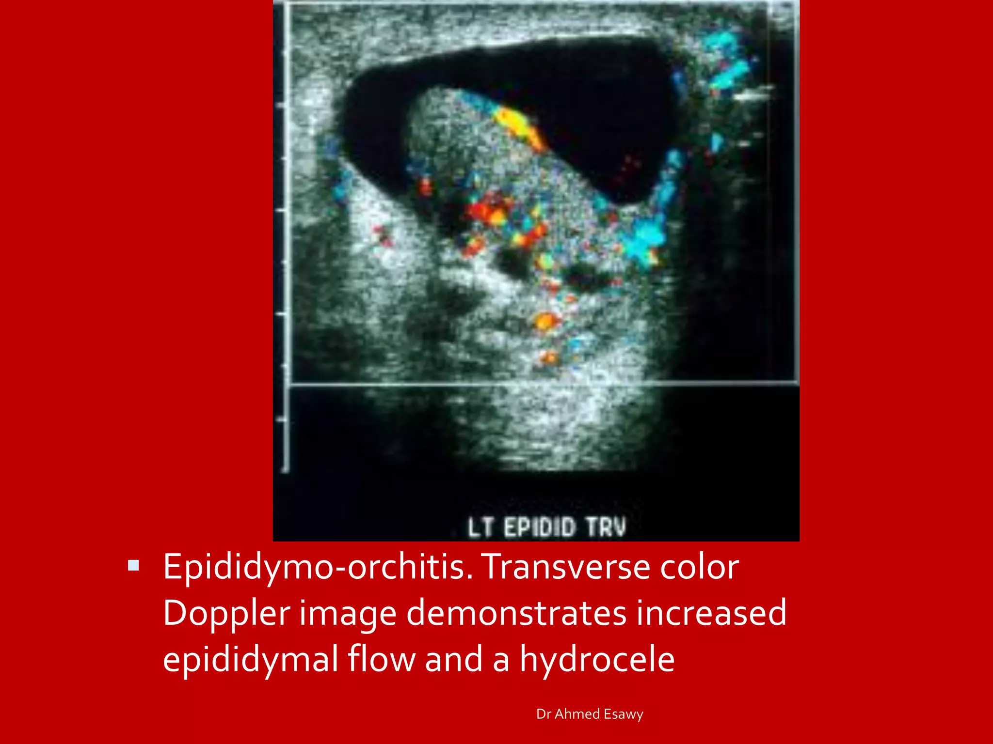 Imaging orchitis epidydmitis epidydmo orchitis DrAhmed Esawy | PDF