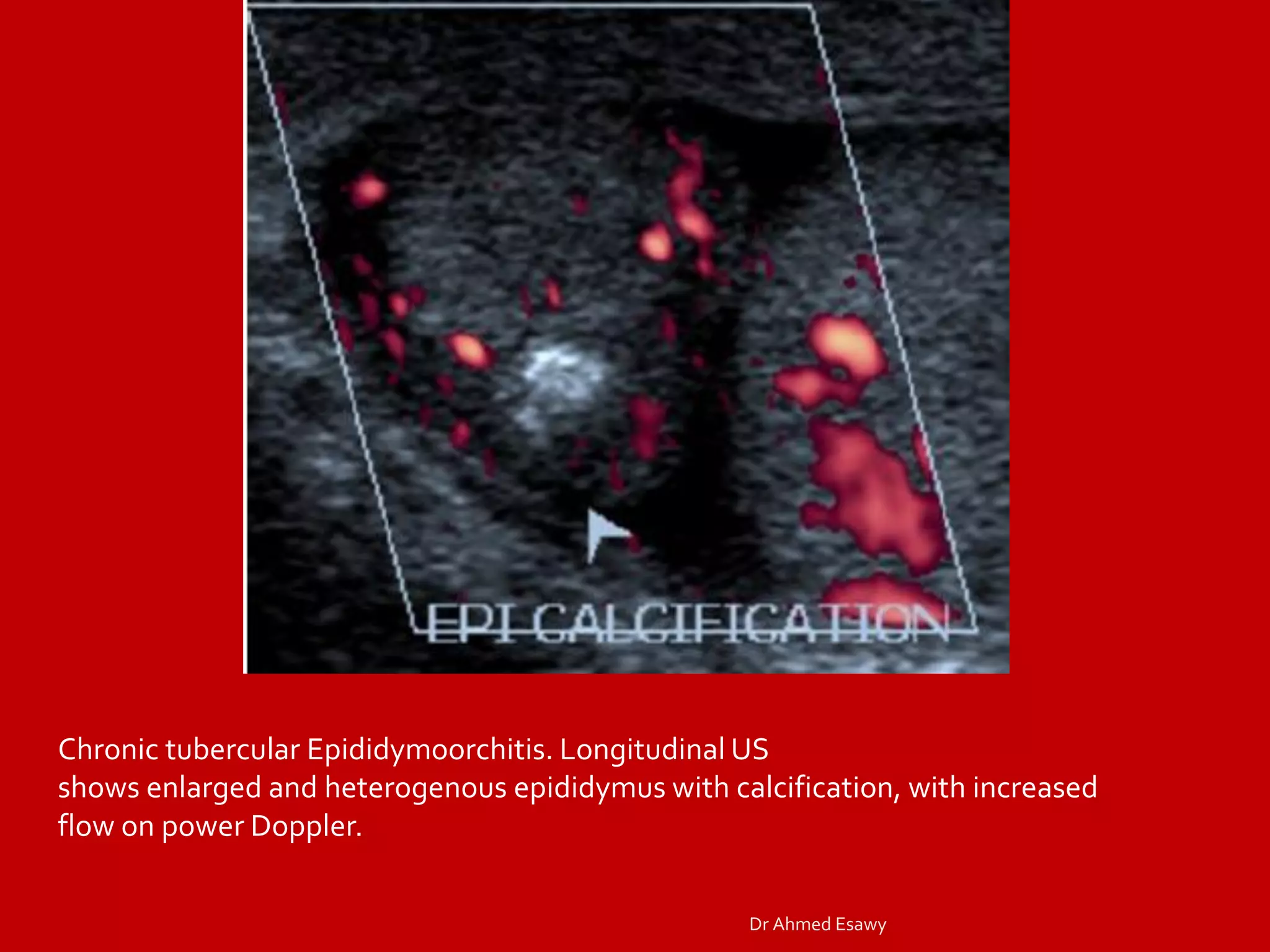 Imaging orchitis epidydmitis epidydmo orchitis DrAhmed Esawy | PDF