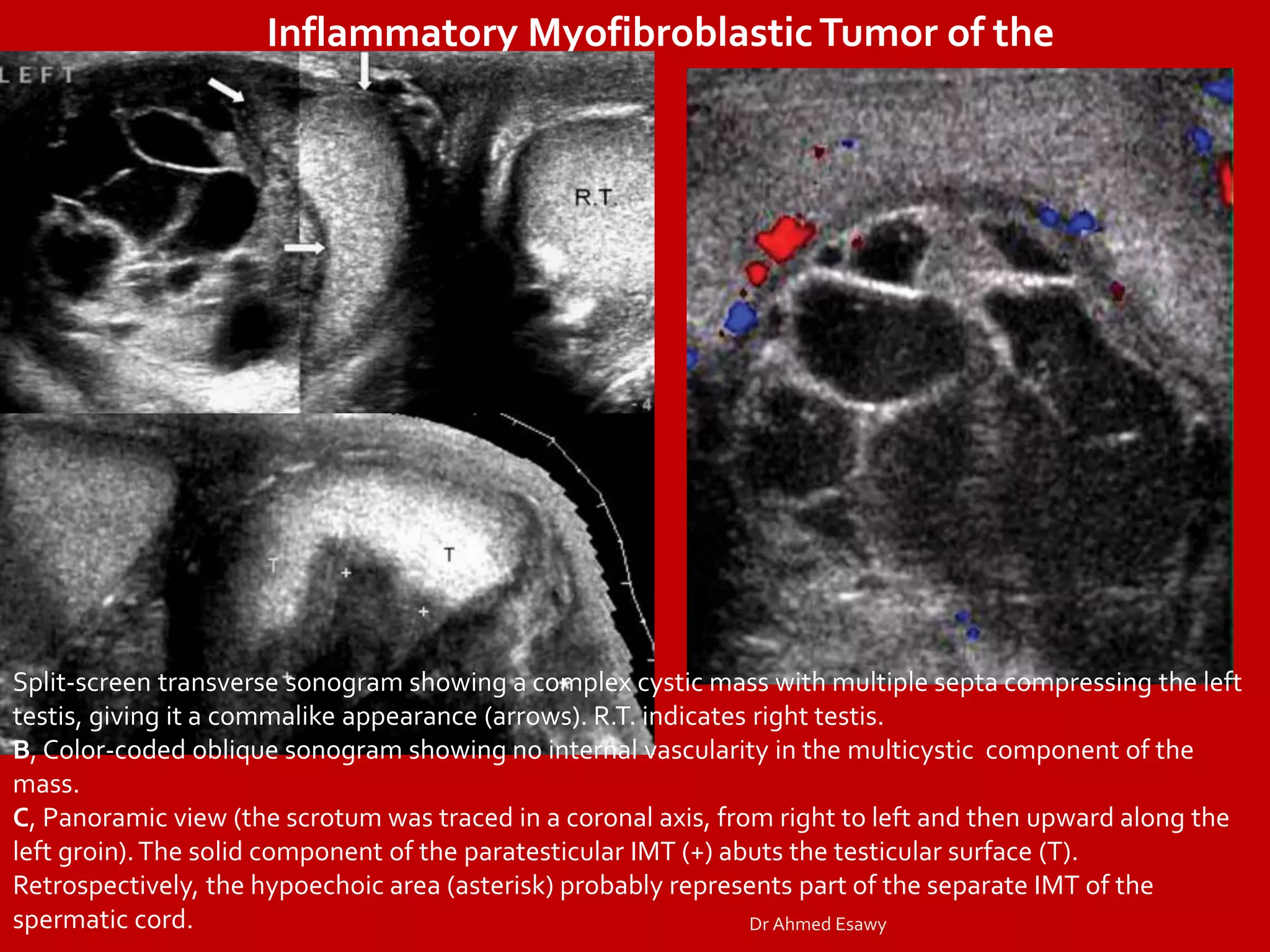 Imaging orchitis epidydmitis epidydmo orchitis DrAhmed Esawy | PDF