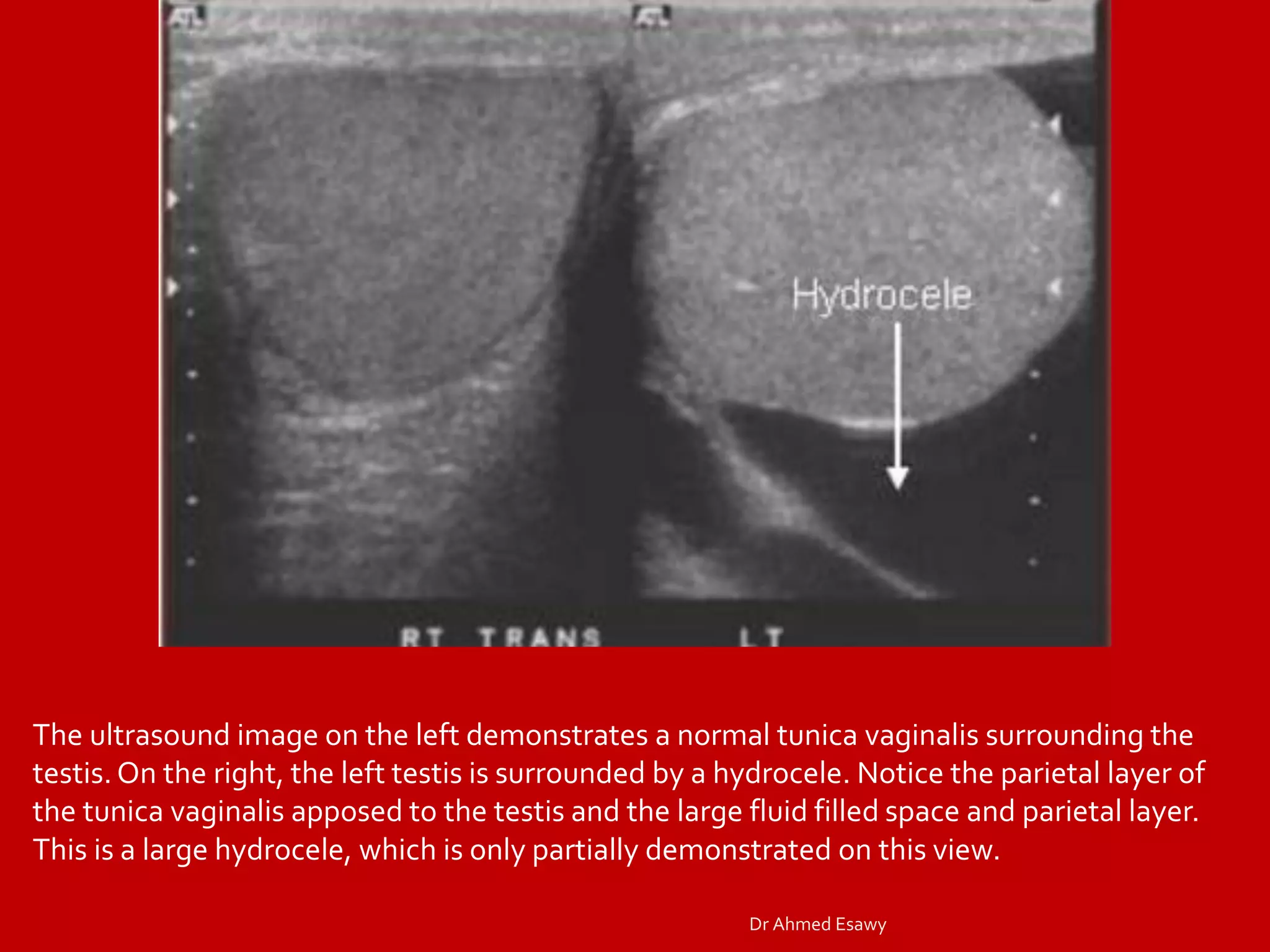 Imaging orchitis epidydmitis epidydmo orchitis DrAhmed Esawy | PDF