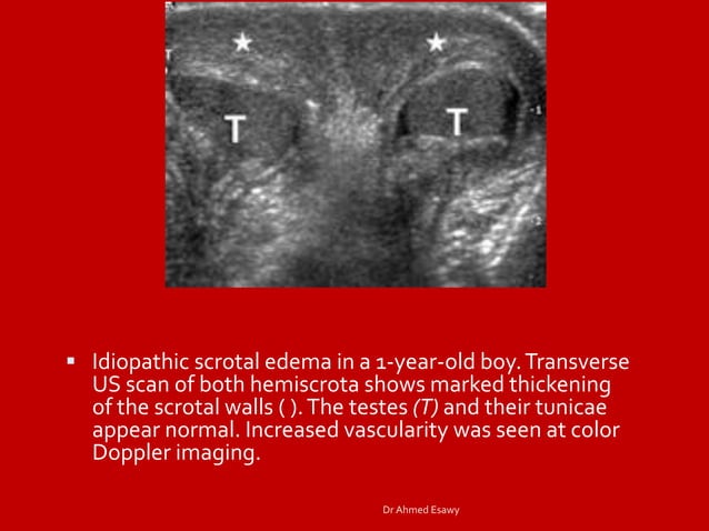 Imaging orchitis epidydmitis epidydmo orchitis DrAhmed Esawy | PDF ...