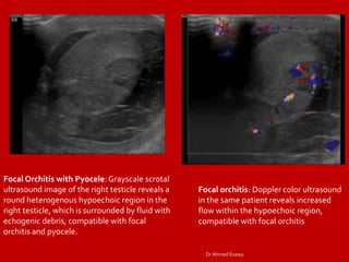 Imaging orchitis epidydmitis epidydmo orchitis DrAhmed Esawy | PDF