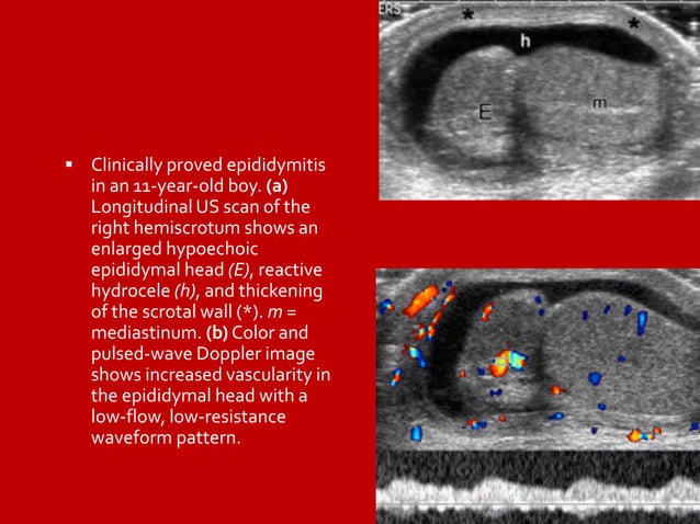 Imaging orchitis epidydmitis epidydmo orchitis DrAhmed Esawy | PDF ...