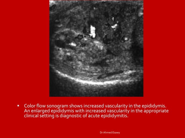 Imaging orchitis epidydmitis epidydmo orchitis DrAhmed Esawy | PDF ...