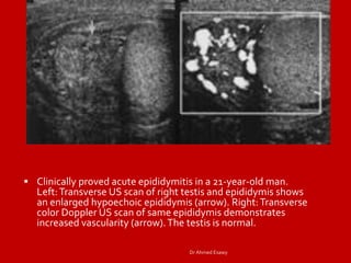 Imaging orchitis epidydmitis epidydmo orchitis DrAhmed Esawy | PDF