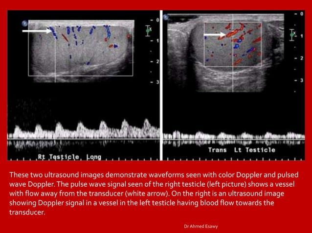 Imaging orchitis epidydmitis epidydmo orchitis DrAhmed Esawy | PDF ...