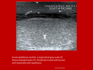 Imaging orchitis epidydmitis epidydmo orchitis DrAhmed Esawy | PDF