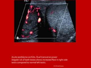 Imaging orchitis epidydmitis epidydmo orchitis DrAhmed Esawy | PDF