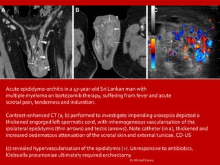 Imaging orchitis epidydmitis epidydmo orchitis DrAhmed Esawy | PDF