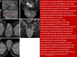 Imaging orchitis epidydmitis epidydmo orchitis DrAhmed Esawy | PDF