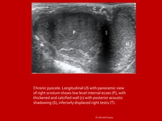 Pyocele Ultrasound