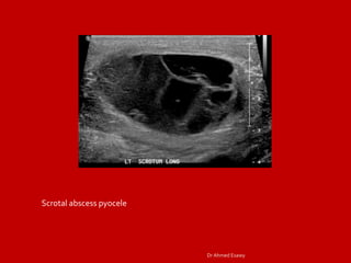 Pyocele Ultrasound