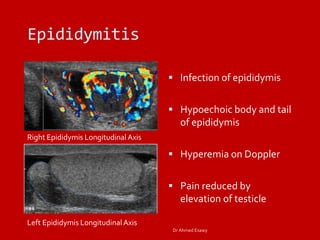 Epididymitis Ultrasound