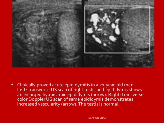 Imaging Orchitis Epidydmitis Epidydmo Orchitis Drahmed Esawy