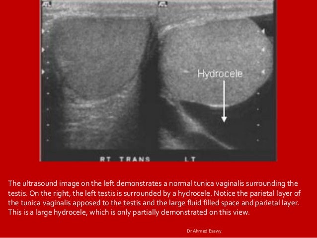 Orchitis Ultrasound