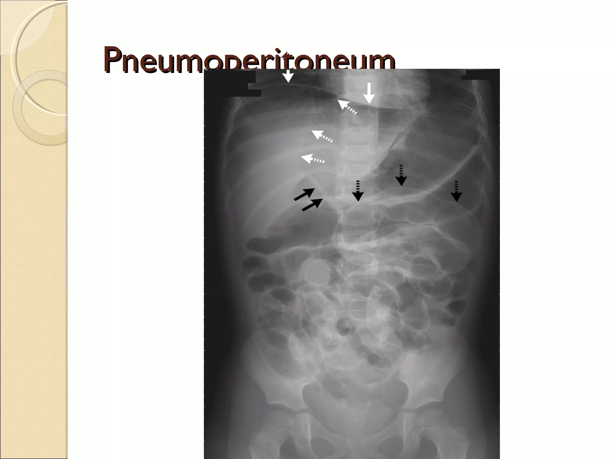 Imaging in acute abdominal pain | PPT