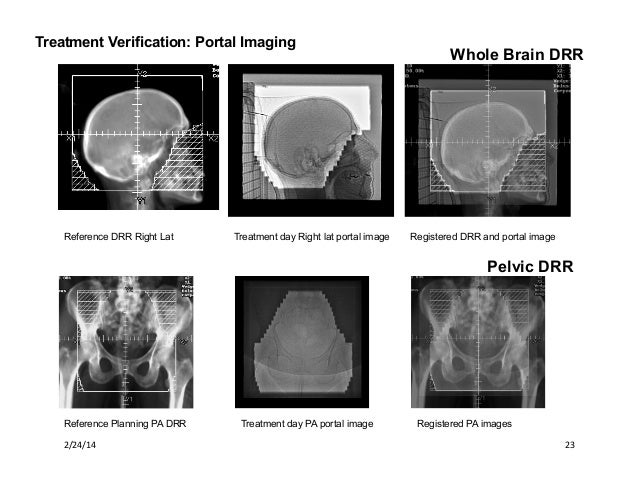 Imaging for Radiotherapy delivery and verification