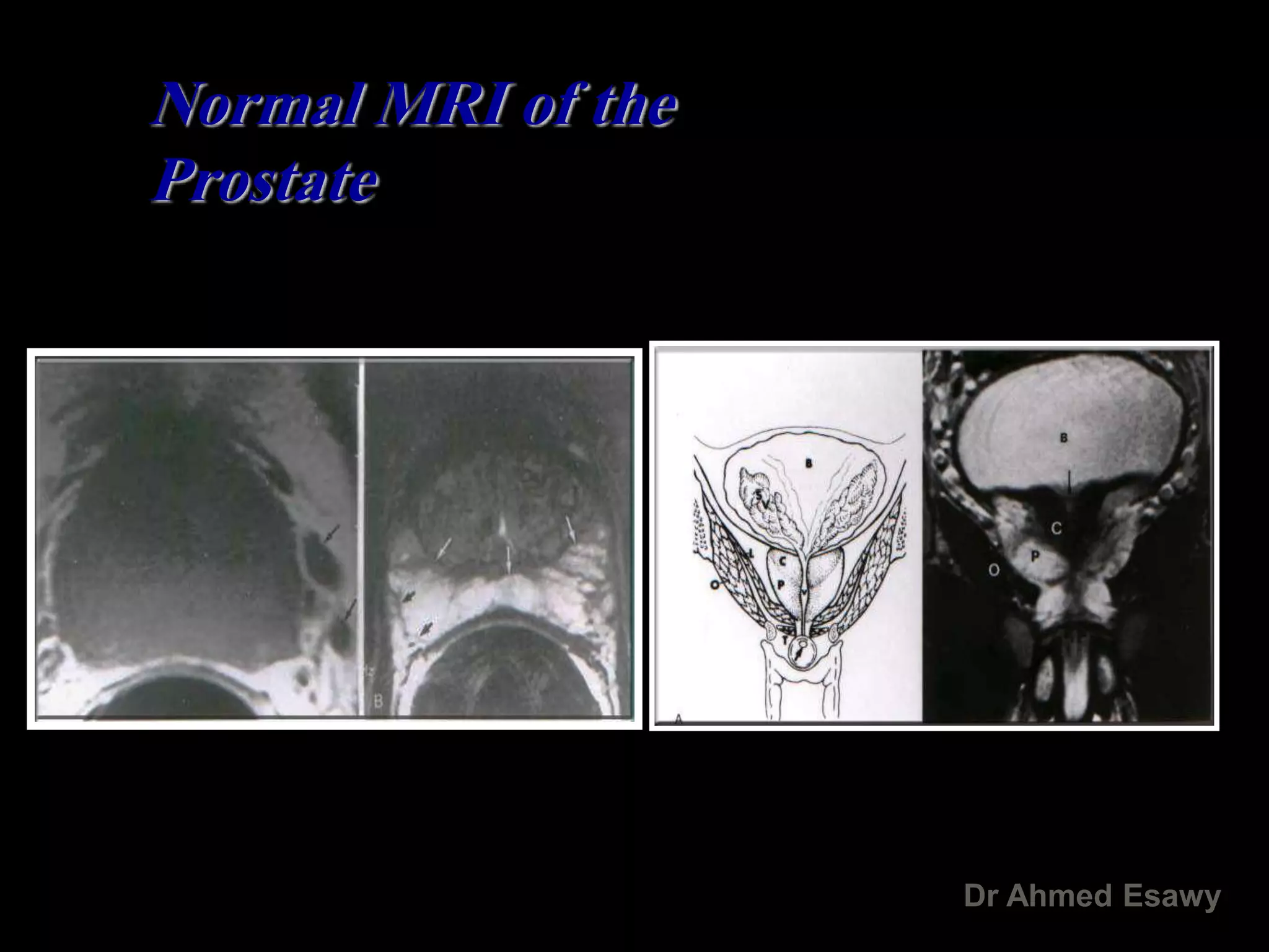 Imaging prostatitis ,urethritis Dr Ahmed Esawy | PDF