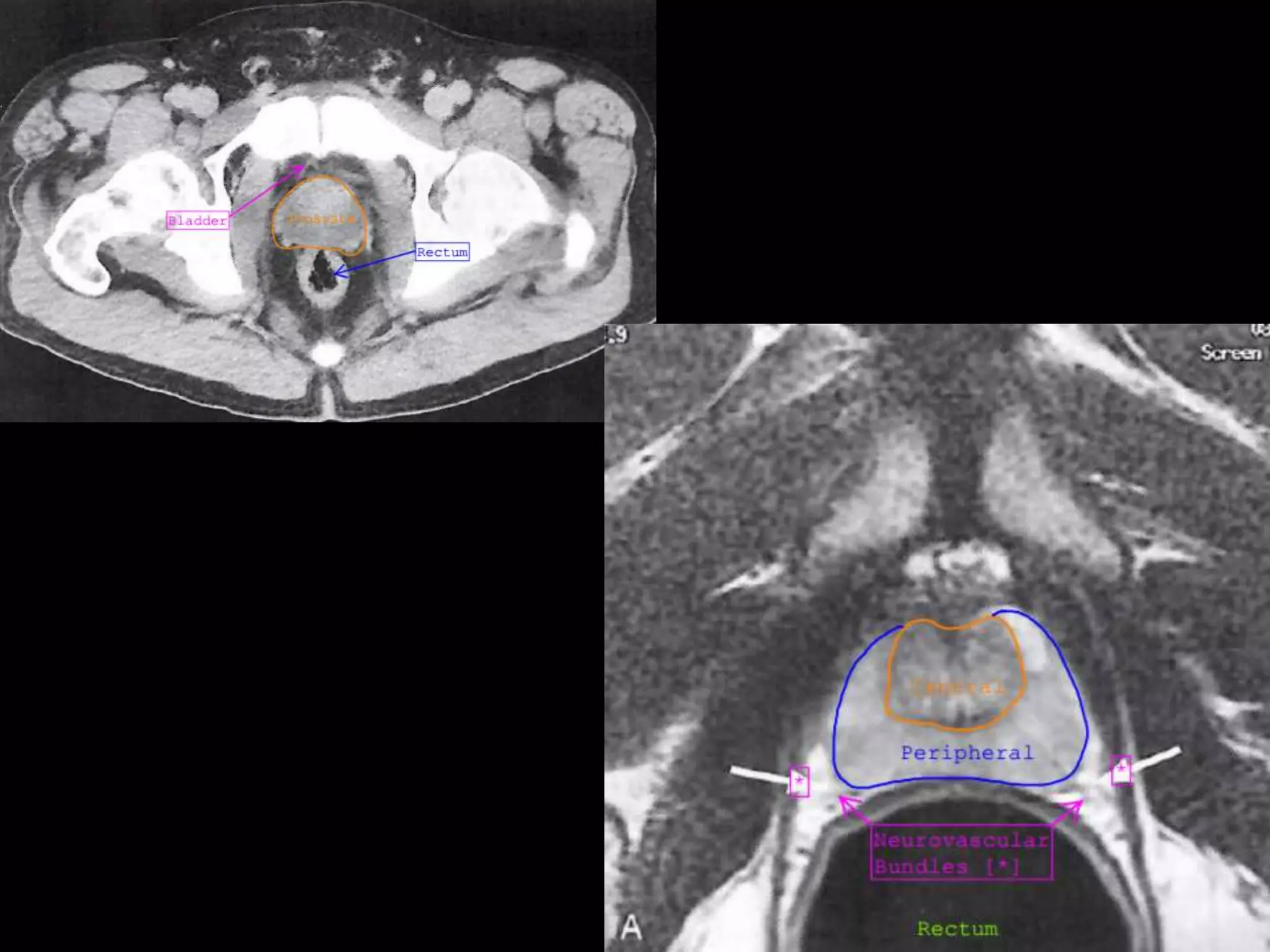 Imaging prostatitis ,urethritis Dr Ahmed Esawy | PDF