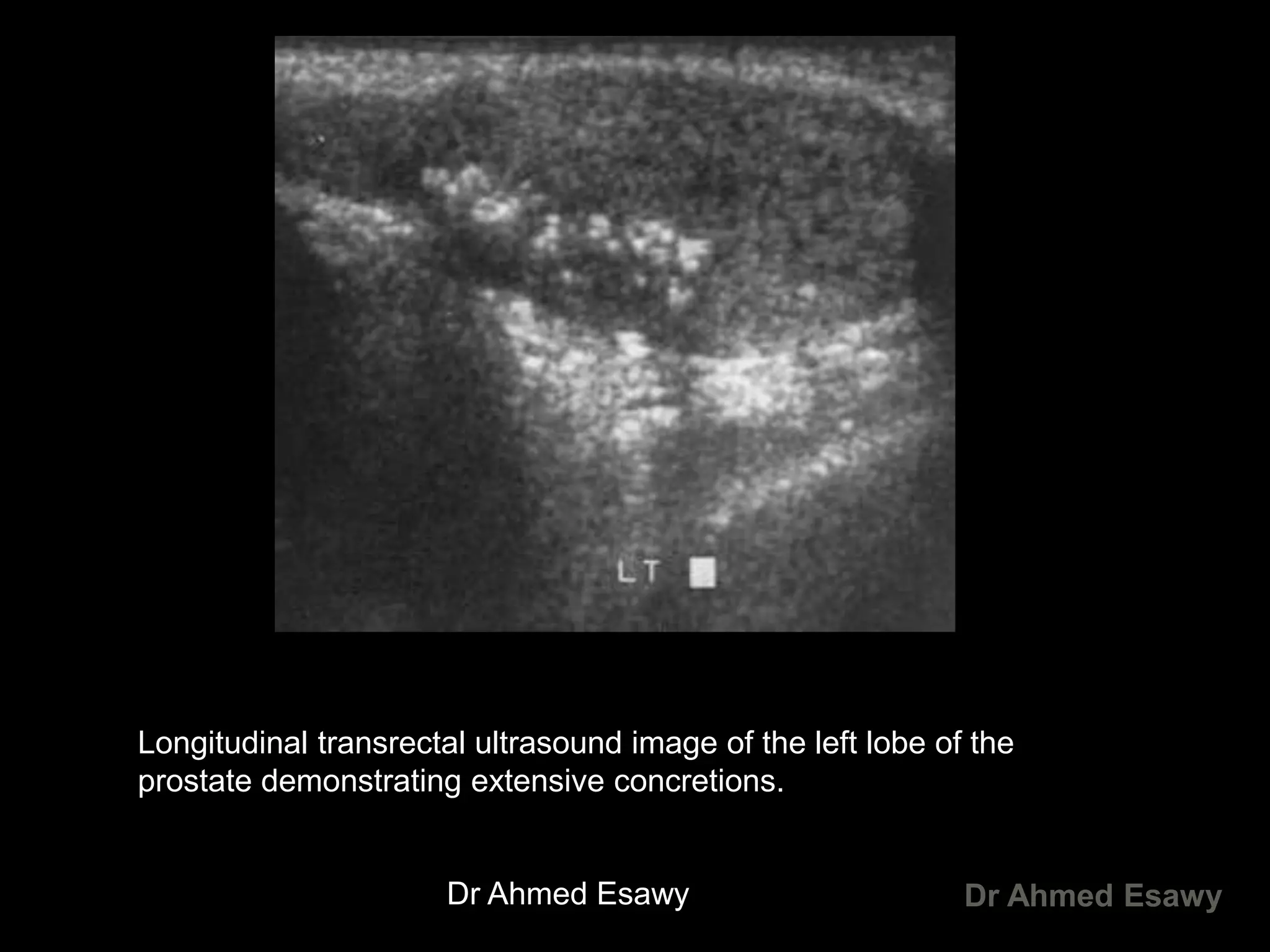 Imaging prostatitis ,urethritis Dr Ahmed Esawy | PDF