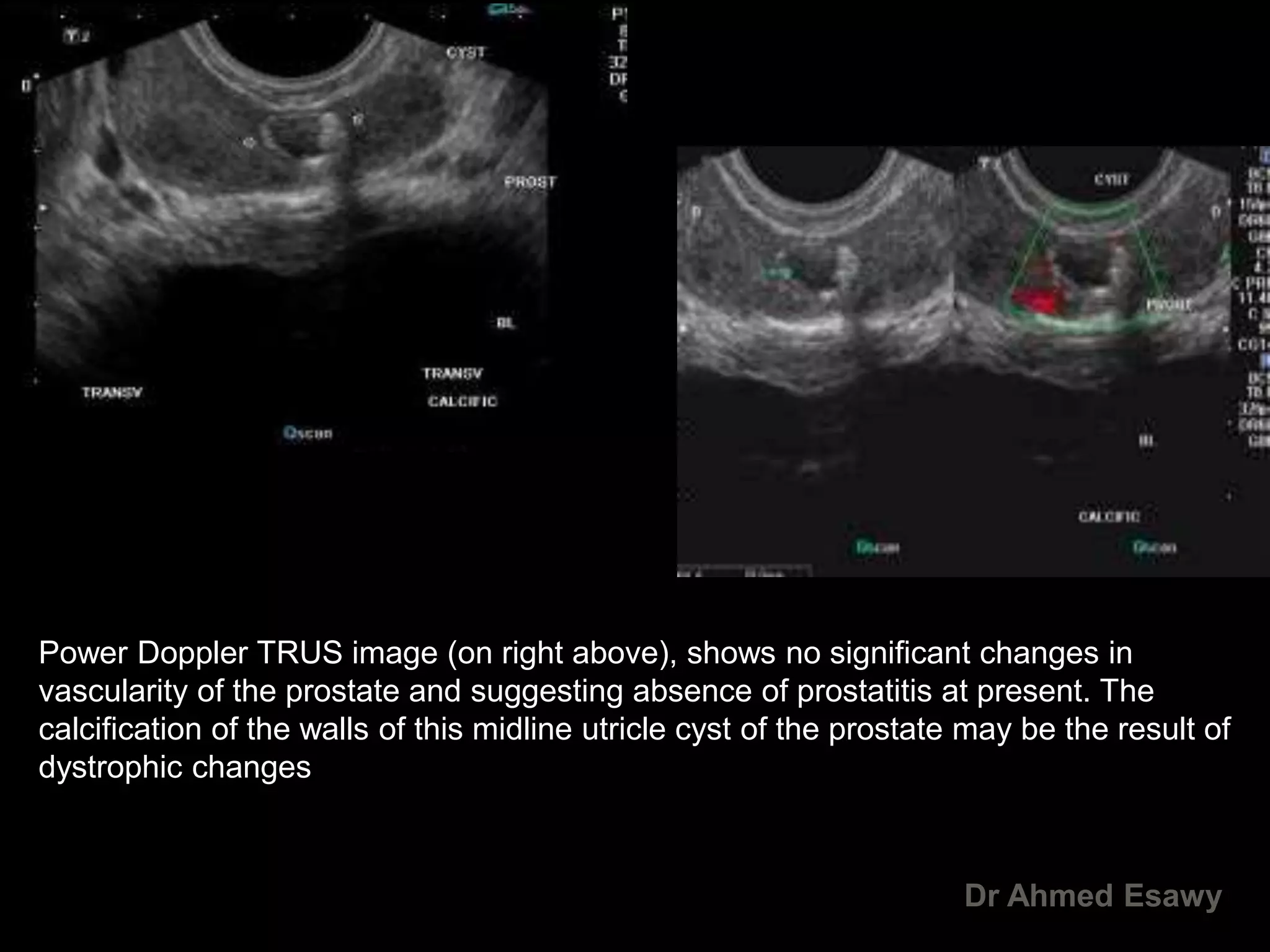 Imaging prostatitis ,urethritis Dr Ahmed Esawy | PDF