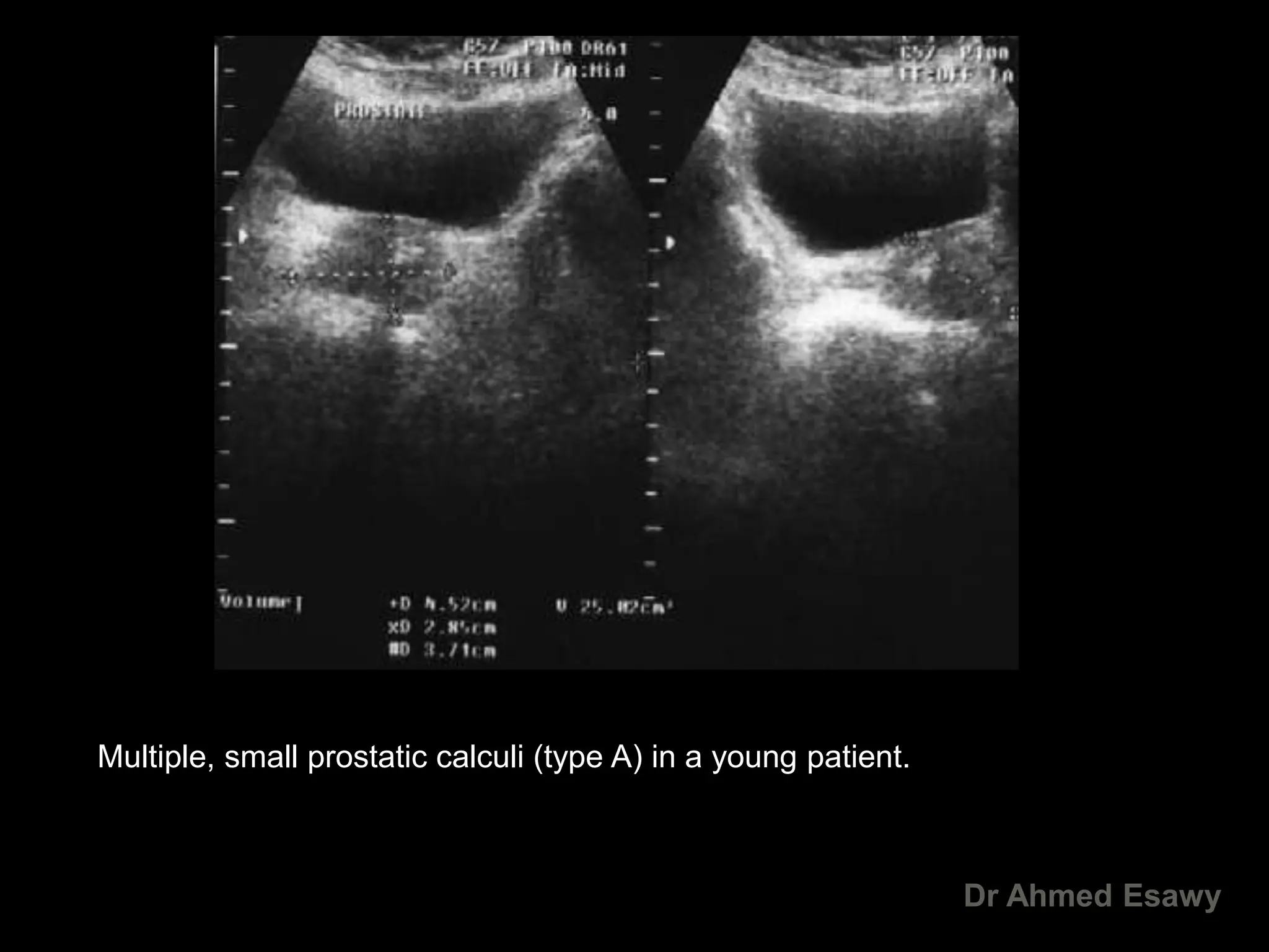 Imaging prostatitis ,urethritis Dr Ahmed Esawy | PDF