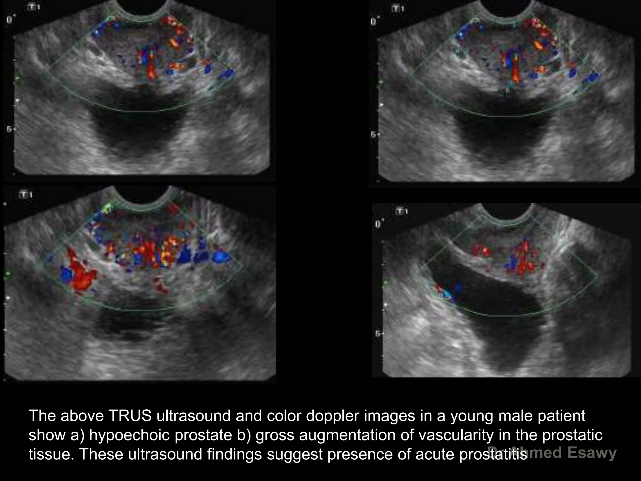 Imaging prostatitis ,urethritis Dr Ahmed Esawy | PDF