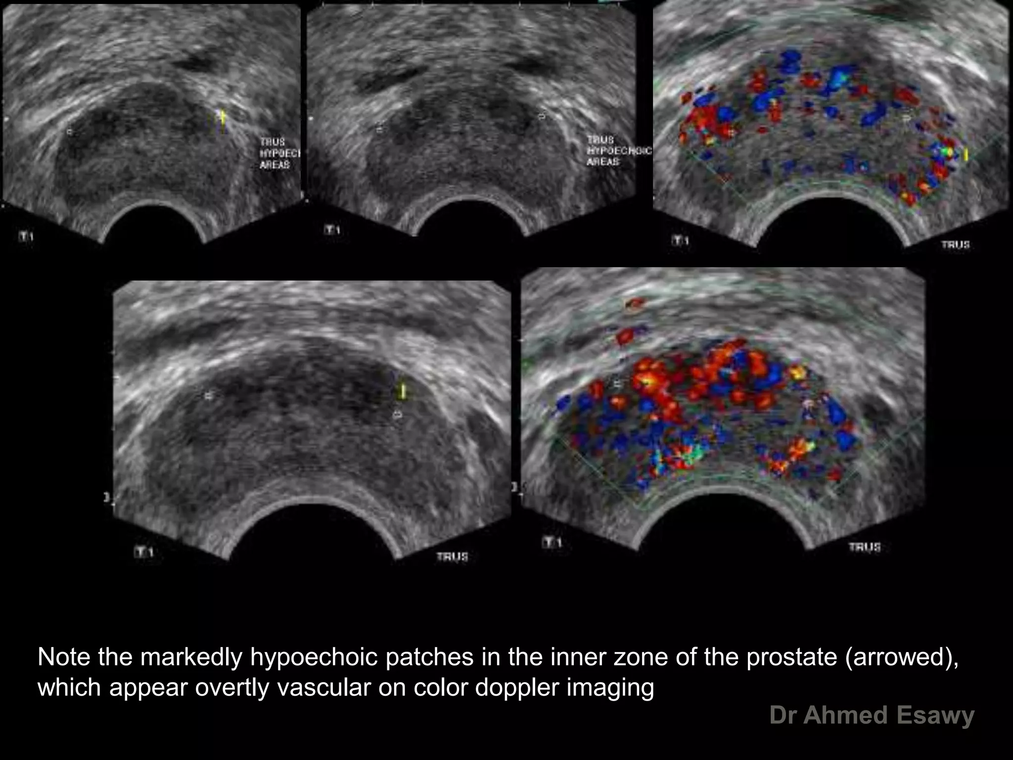 Imaging prostatitis ,urethritis Dr Ahmed Esawy | PDF