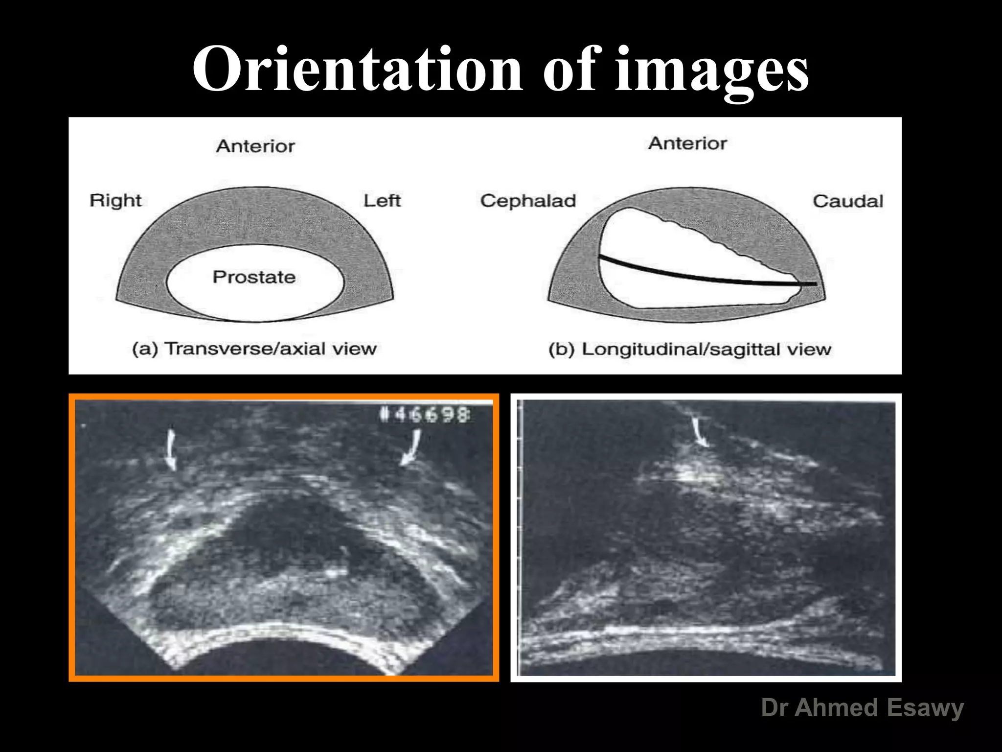 Imaging prostatitis ,urethritis Dr Ahmed Esawy | PDF
