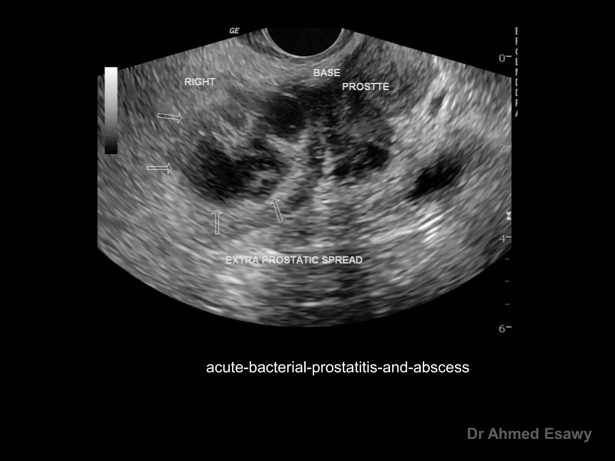 Imaging prostatitis ,urethritis Dr Ahmed Esawy | PDF
