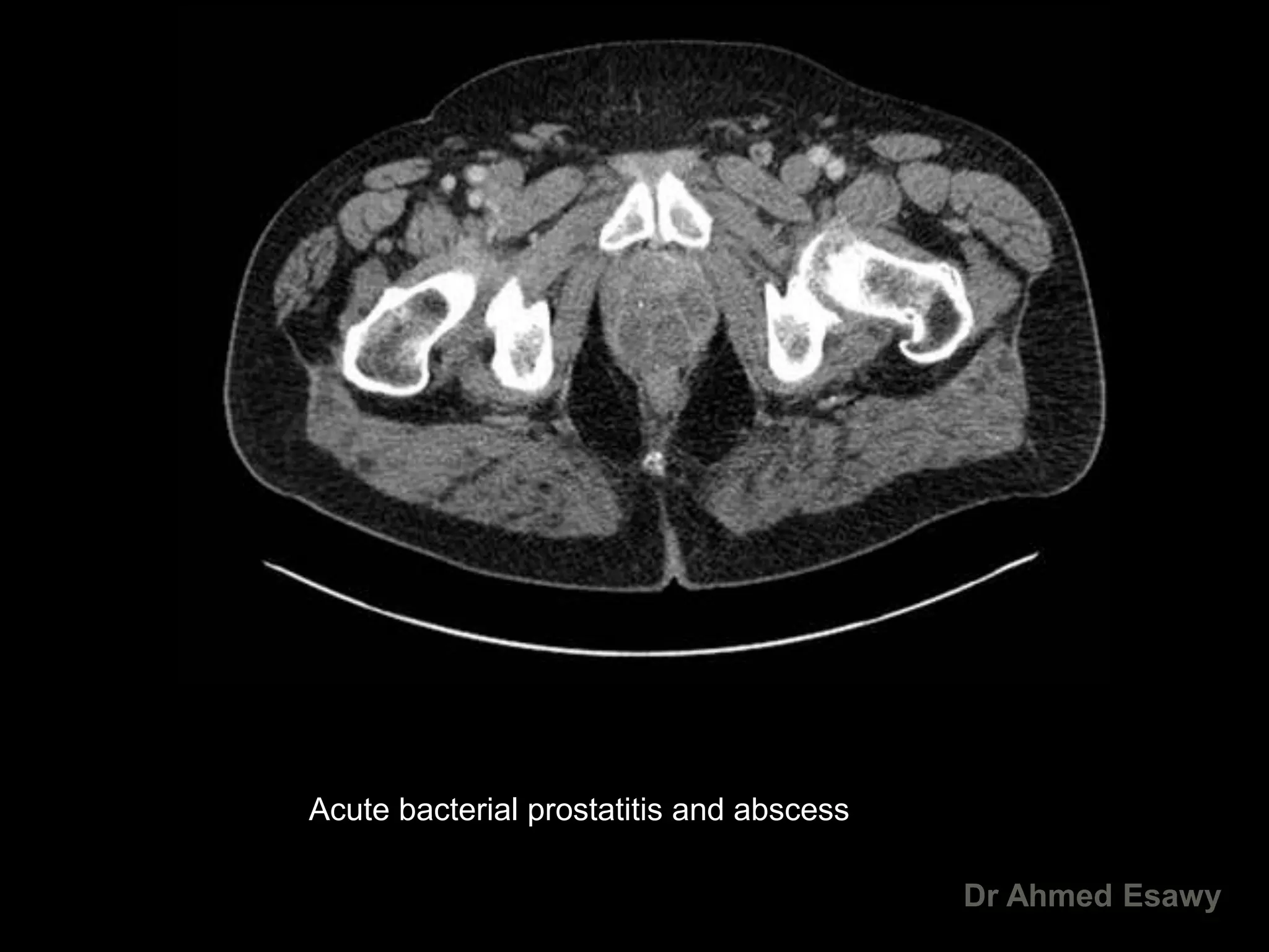 Imaging prostatitis ,urethritis Dr Ahmed Esawy | PDF