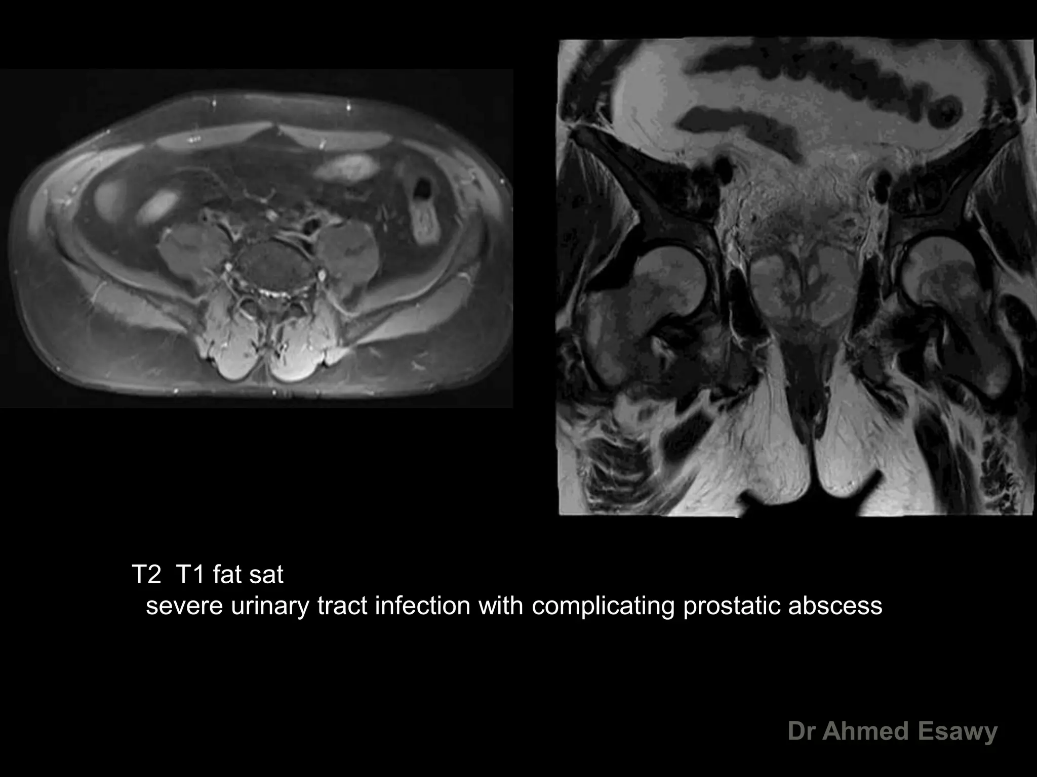 Imaging prostatitis ,urethritis Dr Ahmed Esawy | PDF