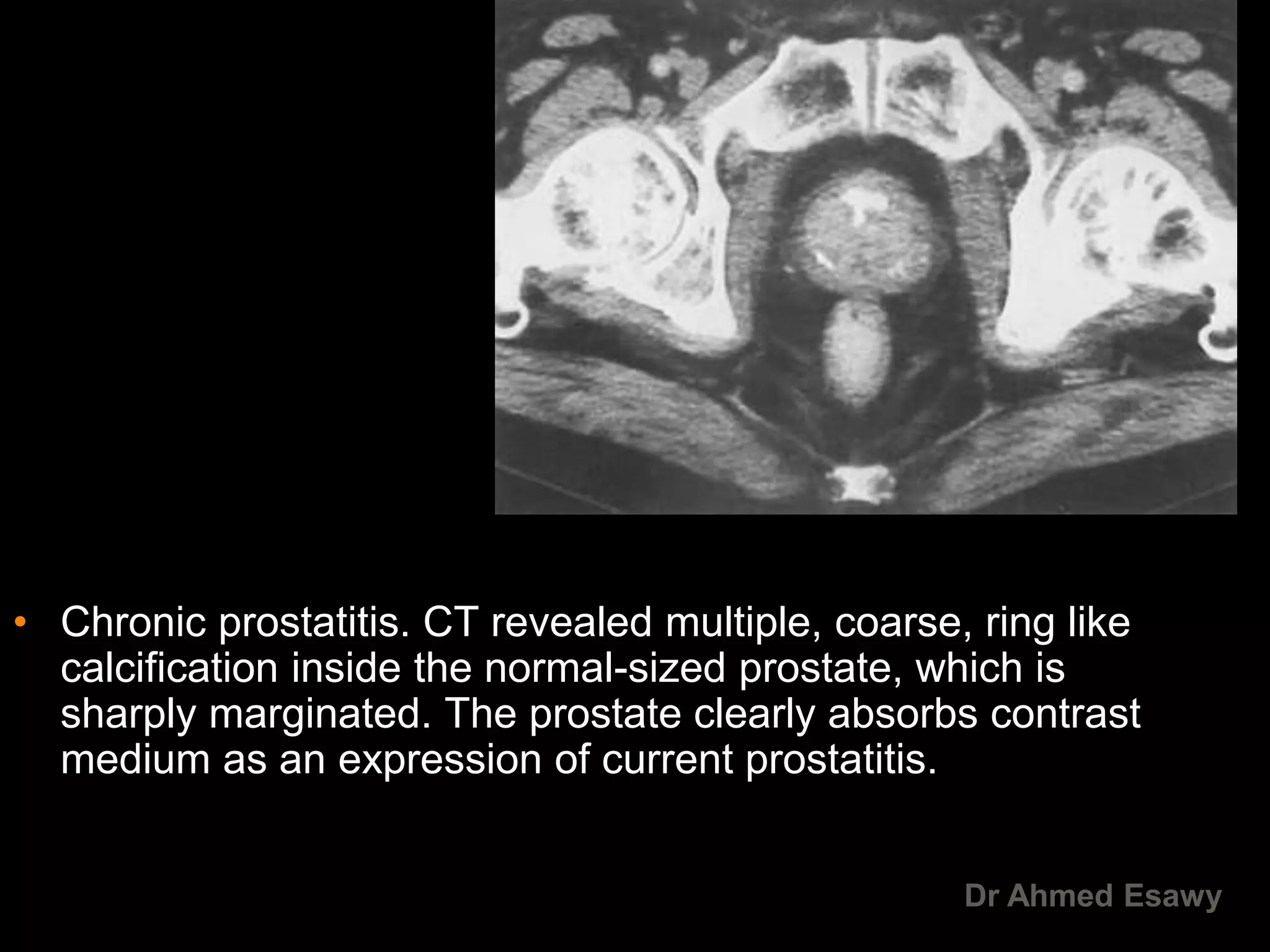 Imaging prostatitis ,urethritis Dr Ahmed Esawy | PDF