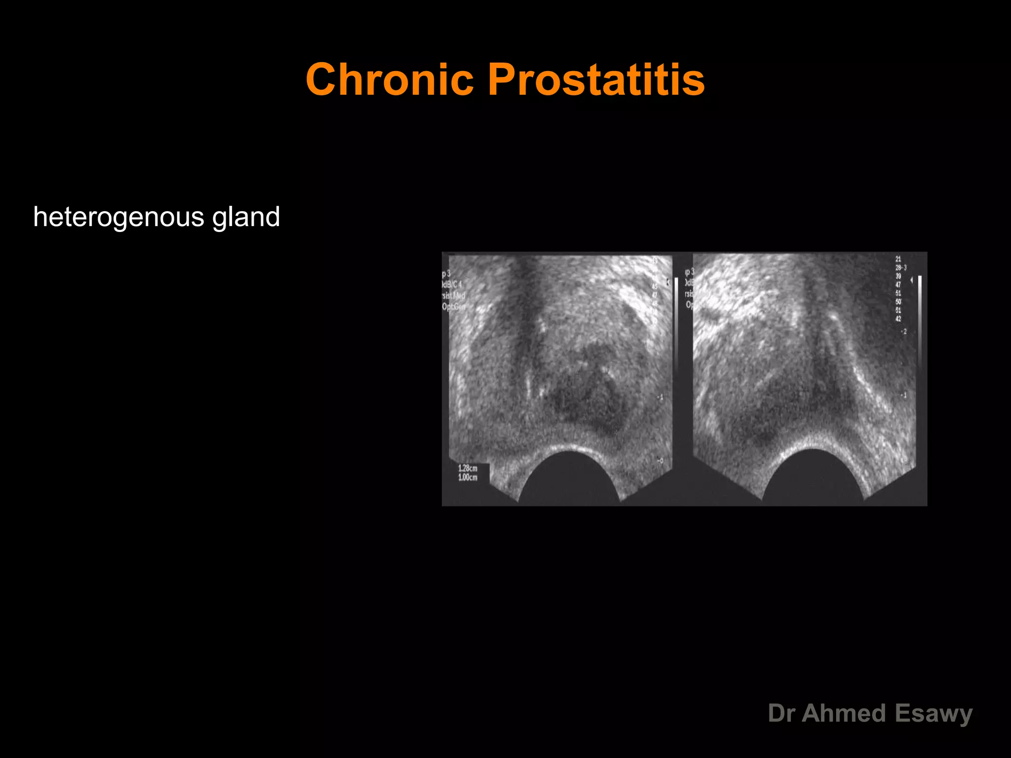 Imaging prostatitis ,urethritis Dr Ahmed Esawy | PDF