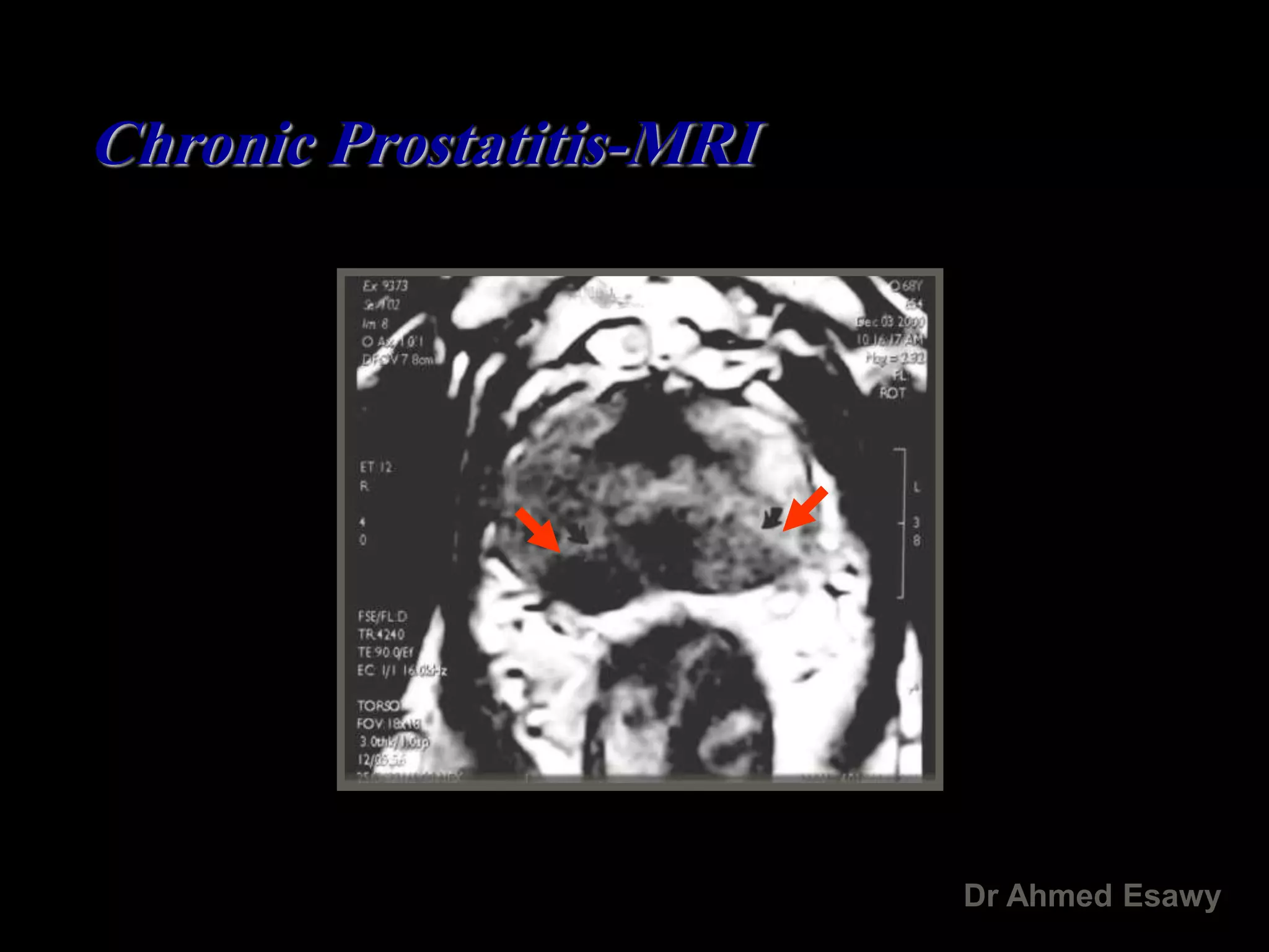 Imaging prostatitis ,urethritis Dr Ahmed Esawy | PDF