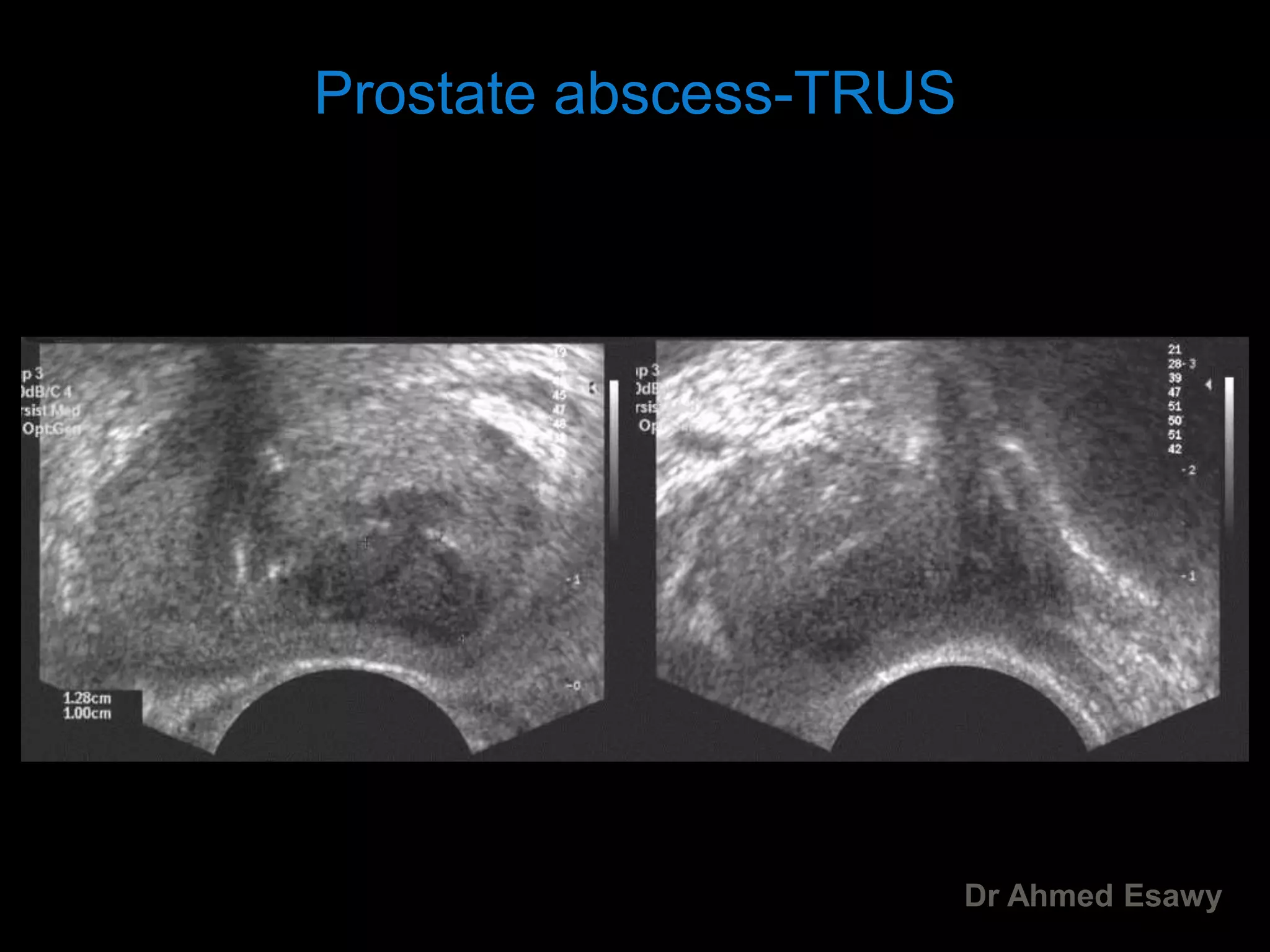 Imaging prostatitis ,urethritis Dr Ahmed Esawy | PDF