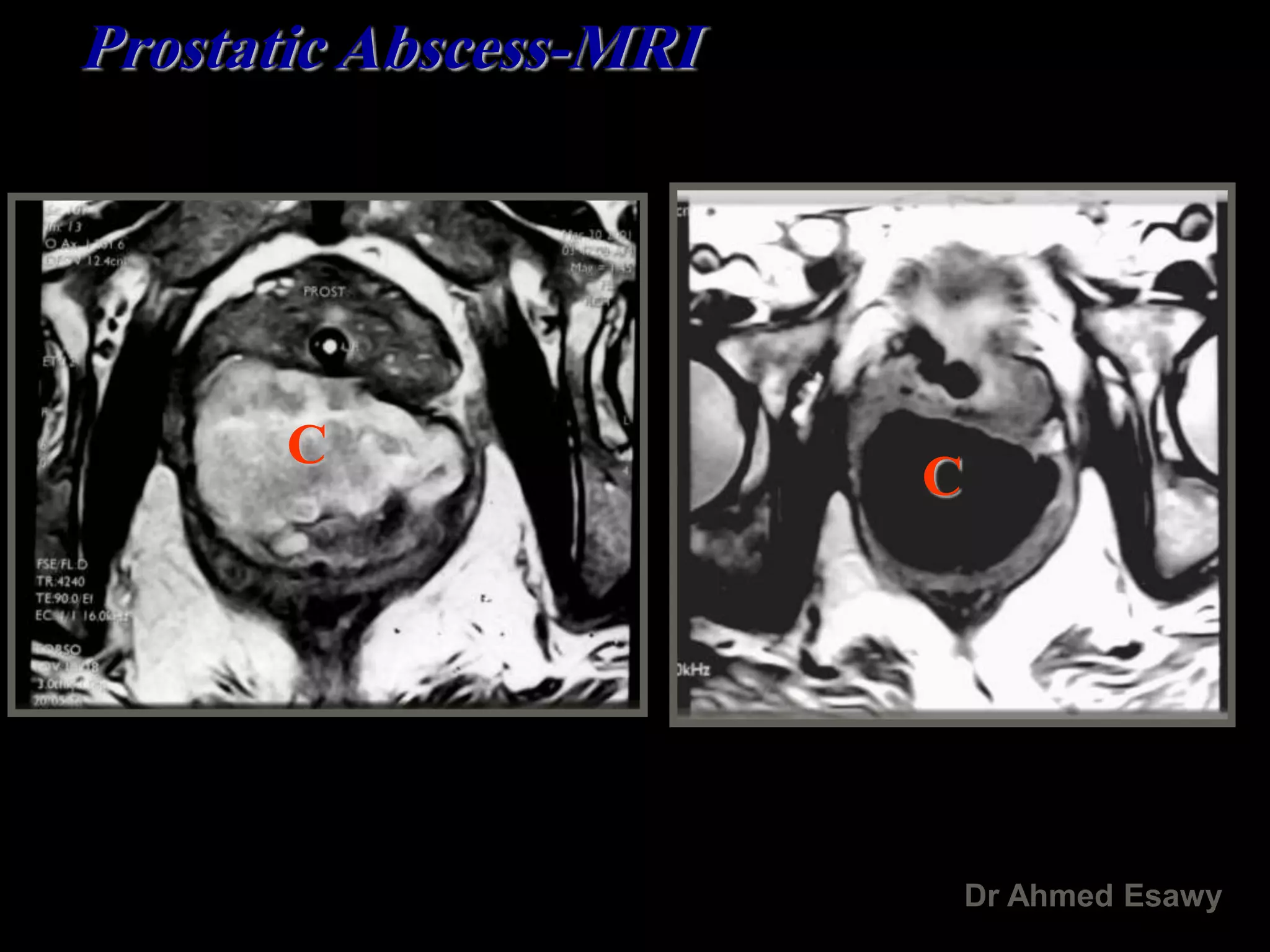 Imaging prostatitis ,urethritis Dr Ahmed Esawy | PDF