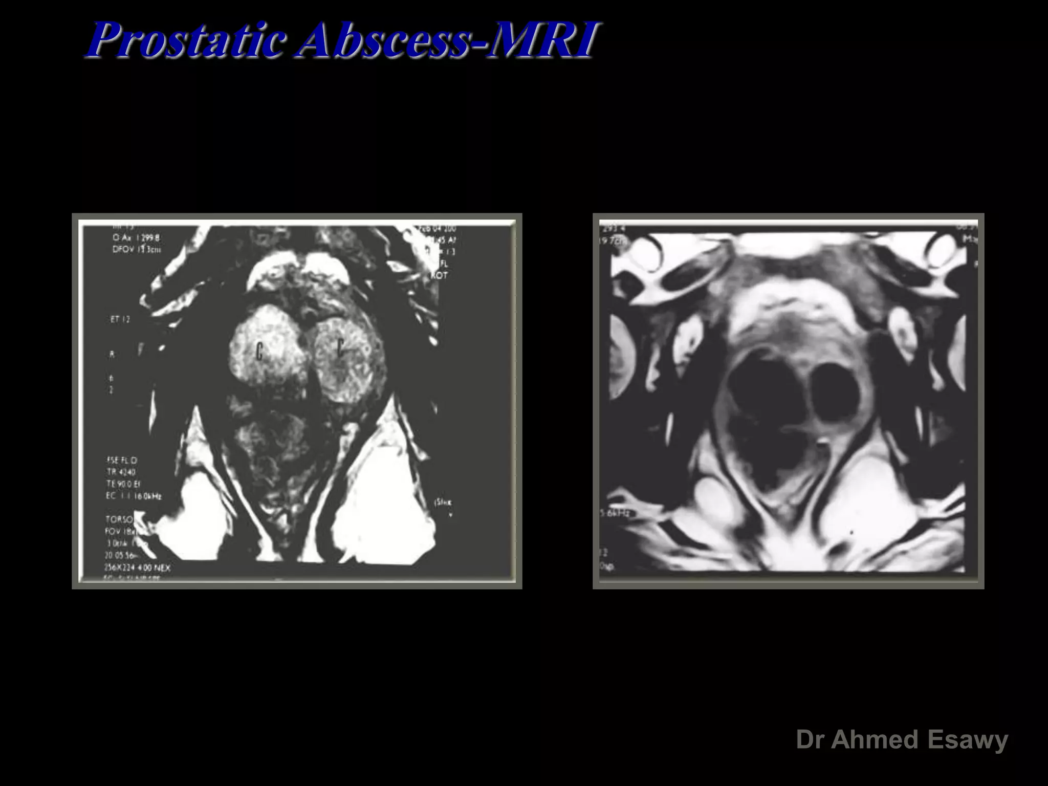 Imaging prostatitis ,urethritis Dr Ahmed Esawy | PDF