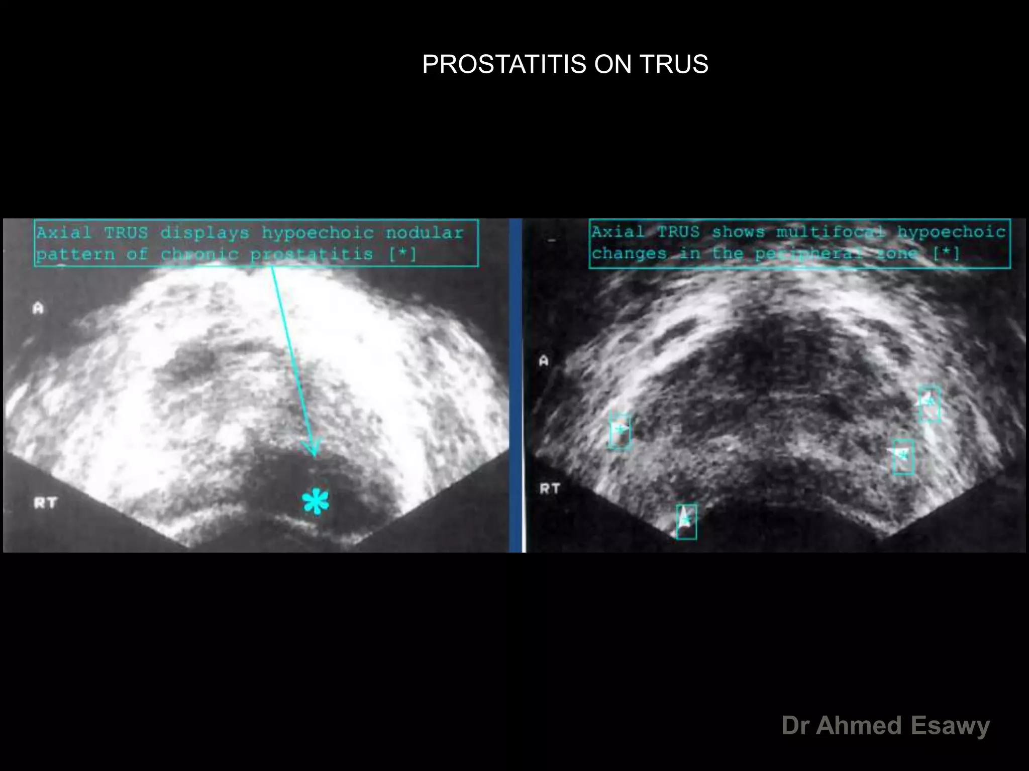Imaging prostatitis ,urethritis Dr Ahmed Esawy | PDF
