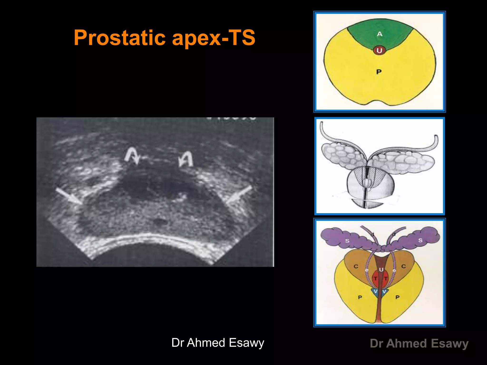 Imaging Prostatitis Urethritis Dr Ahmed Esawy Ppt