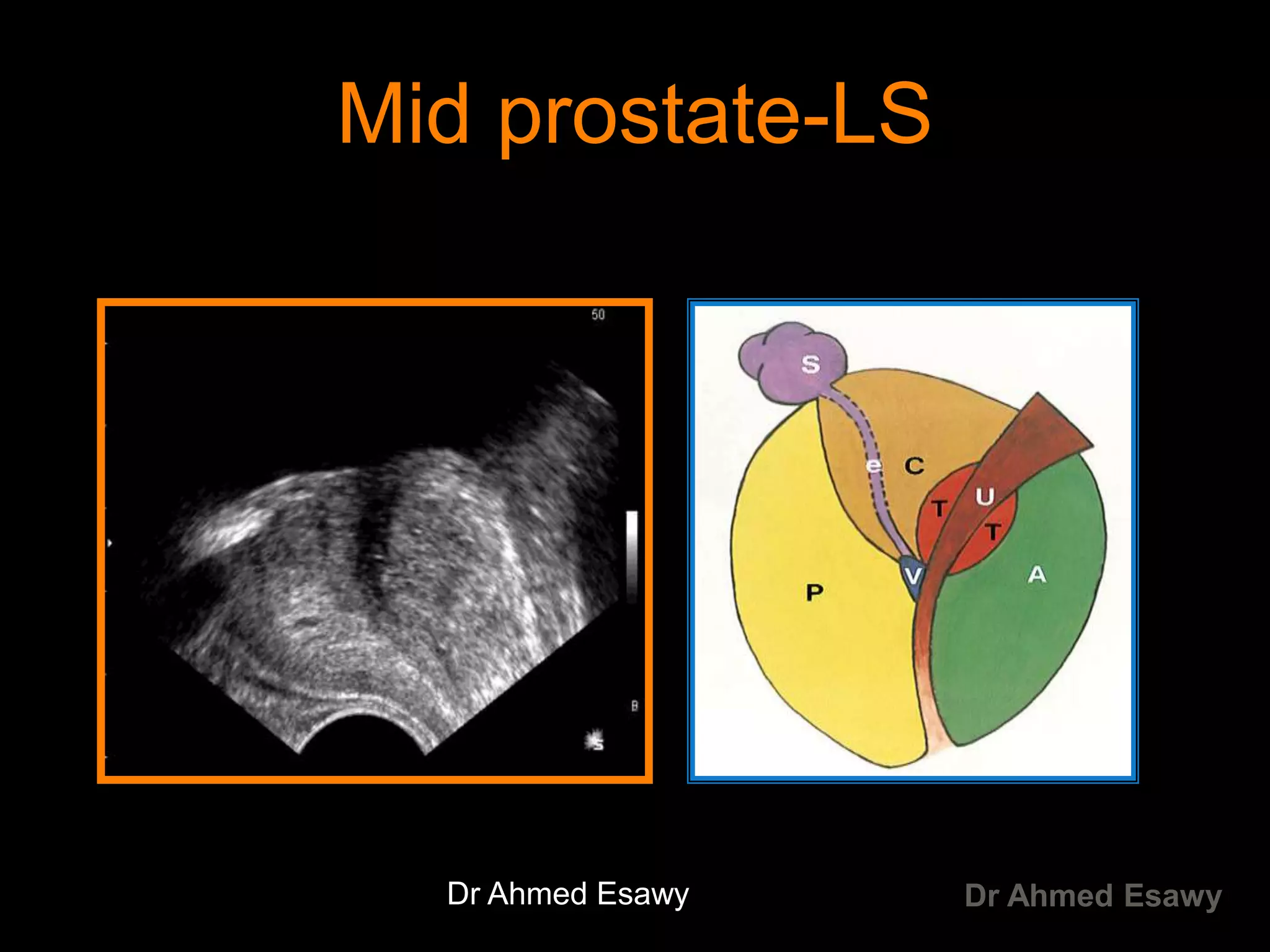 Imaging prostatitis ,urethritis Dr Ahmed Esawy | PDF