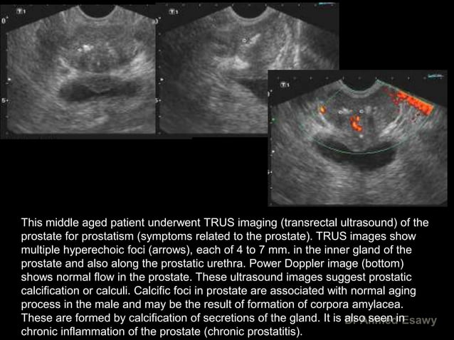 Imaging prostatitis ,urethritis Dr Ahmed Esawy | PDF