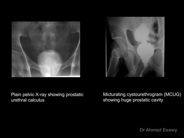 Imaging prostatitis ,urethritis Dr Ahmed Esawy | PDF